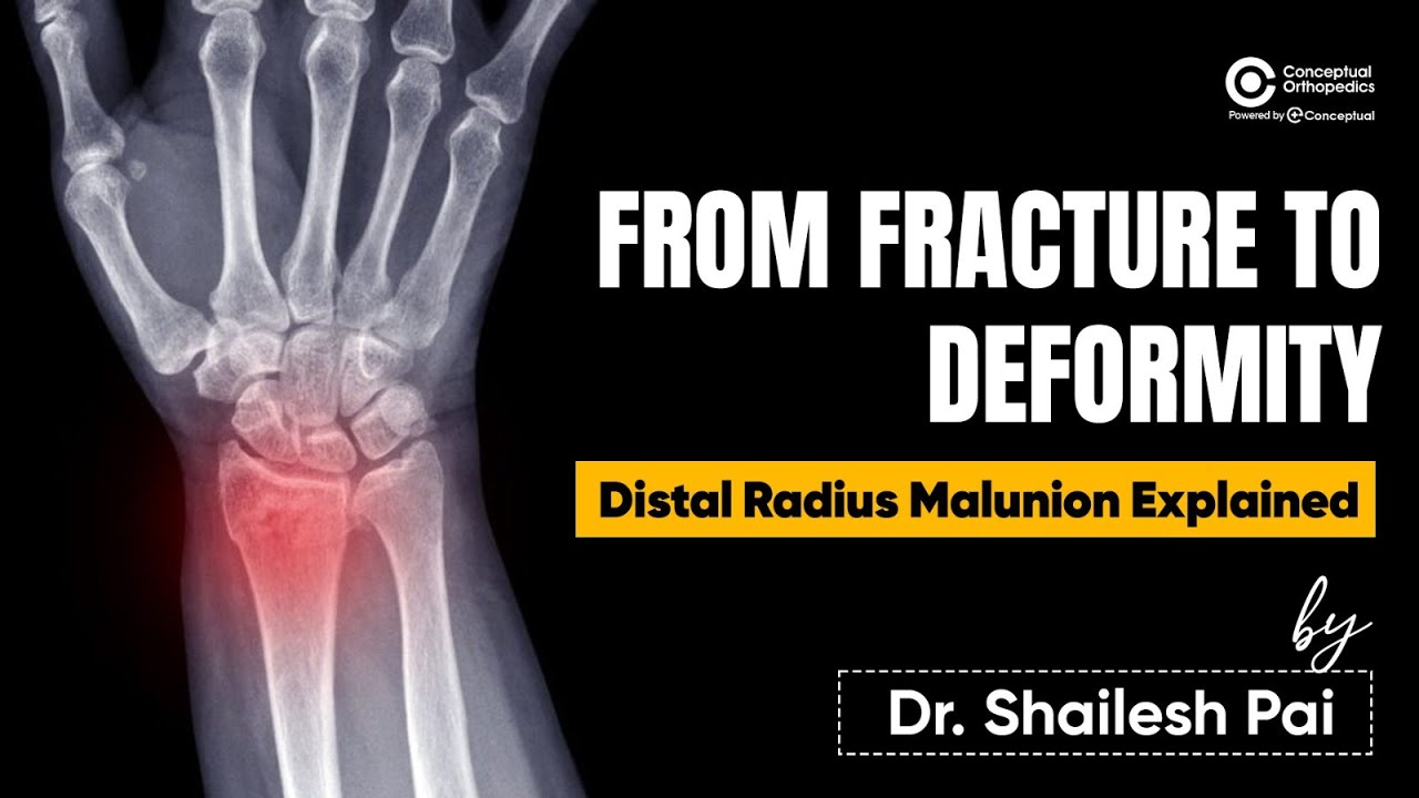 Distal Radius Malunion Simplified for Residents by Dr. Shailesh Pai ...