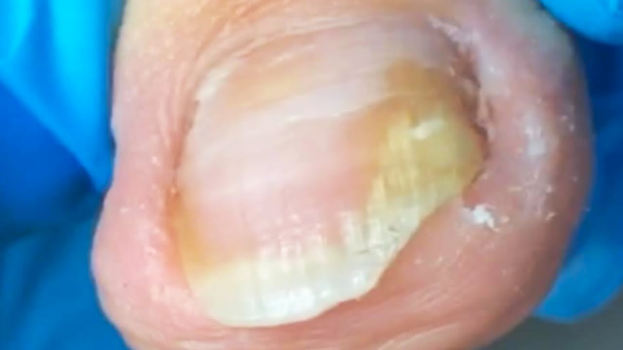Curly Toenails, Trimming Ingrown Toenails And Onychomycosis - YouTube