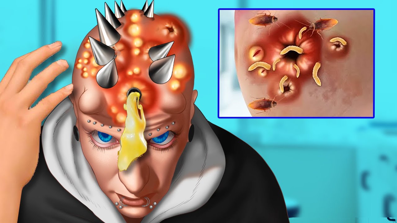 ASMR Popping pustules on head spike biker man with transdermal implant extreme piercing - YouTube