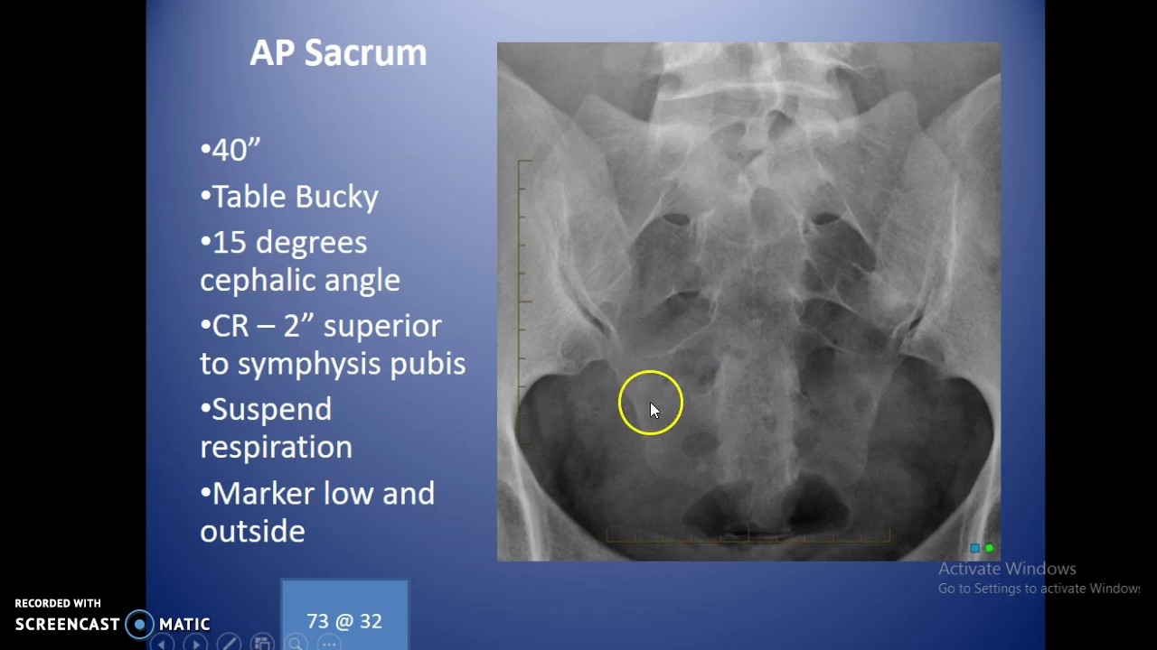 Sacrum And Coccyx X Ray