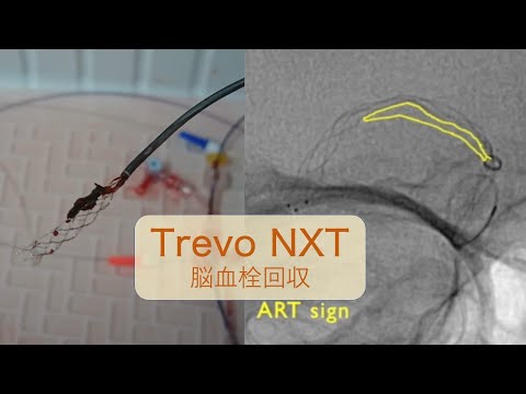 Trevo NXTによる脳血栓回収 - YouTube