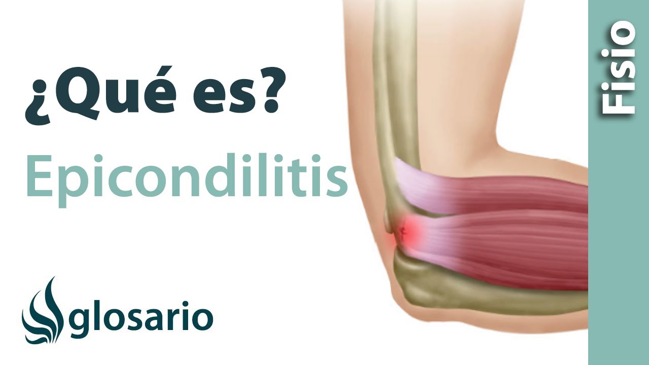 EPICONDILITIS | ¿Qué es? - YouTube