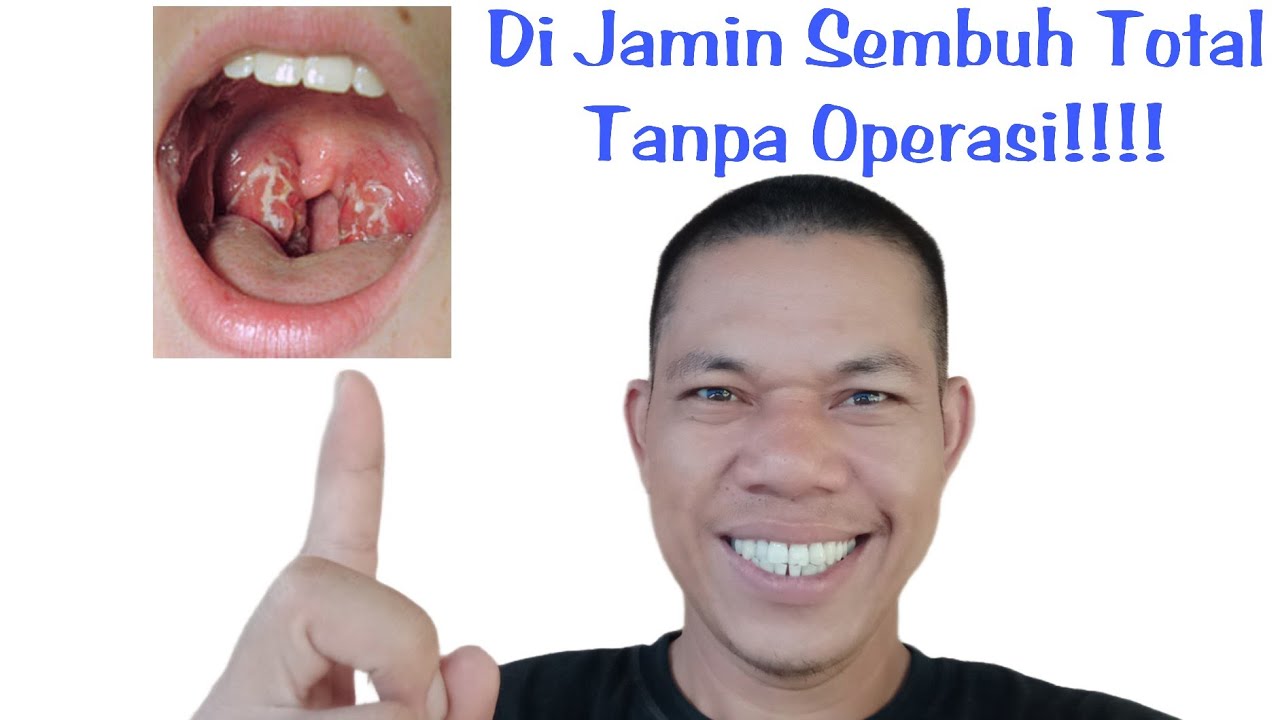 Di Jamin Ampuh Cara Mengatasi Amandel Yang Parah Tanpa Operasi Youtube