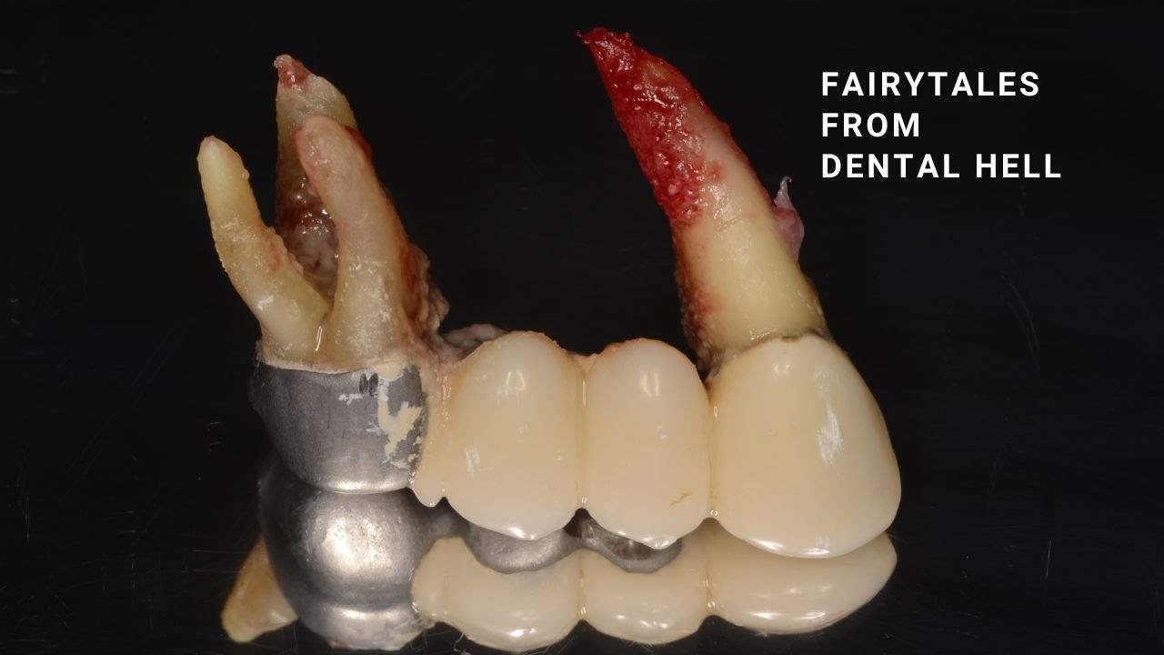 DENTAL BRIDGE REMOVAL #dentist #asmr - YouTube