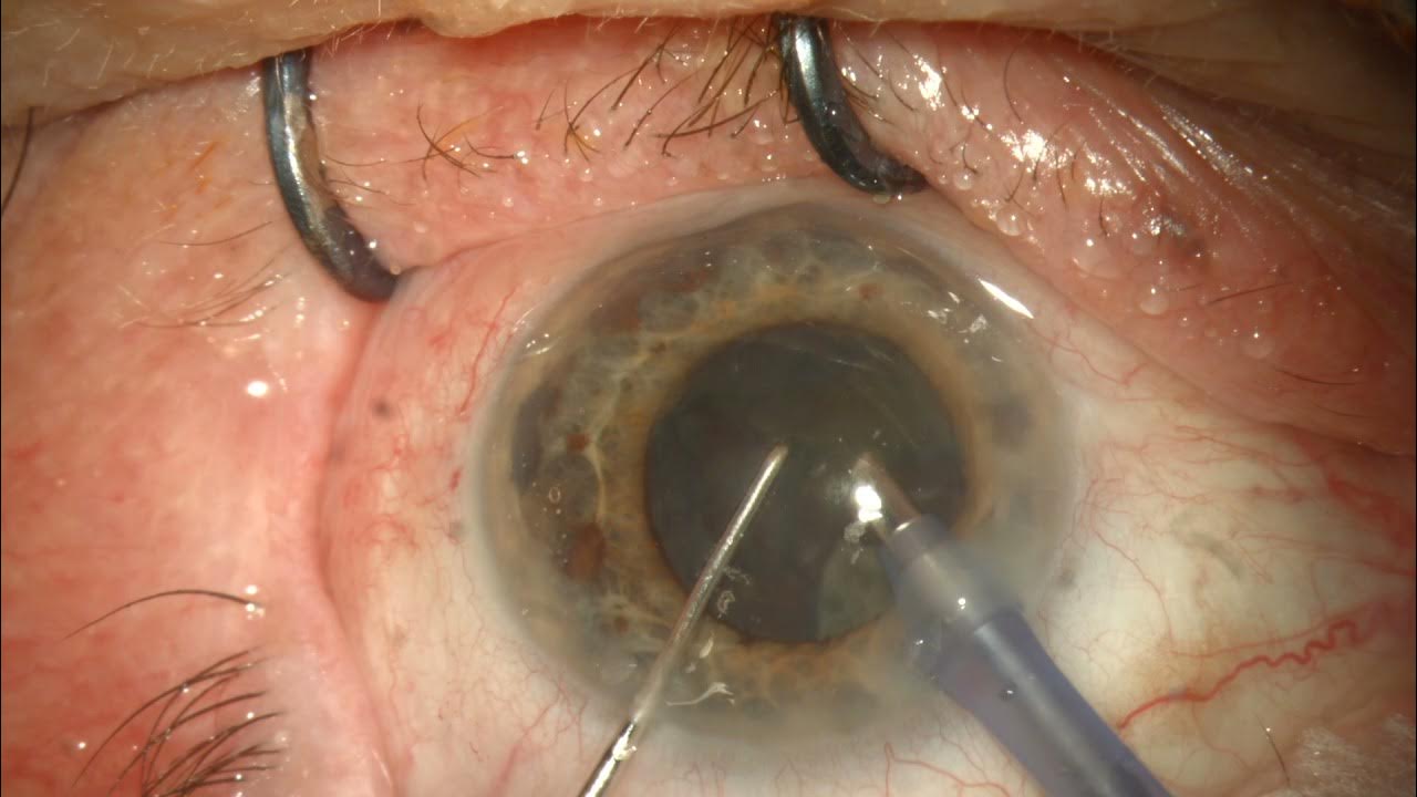 Phaco + Lisch nodules (Neurofibromatosis or von Recklinghausen disease ...