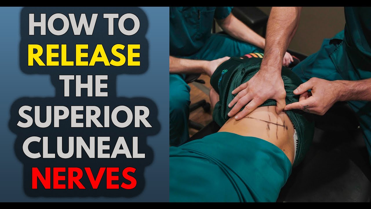 How To Release Superior Cluneal Nerve Entrapments with Adhesion Release ...
