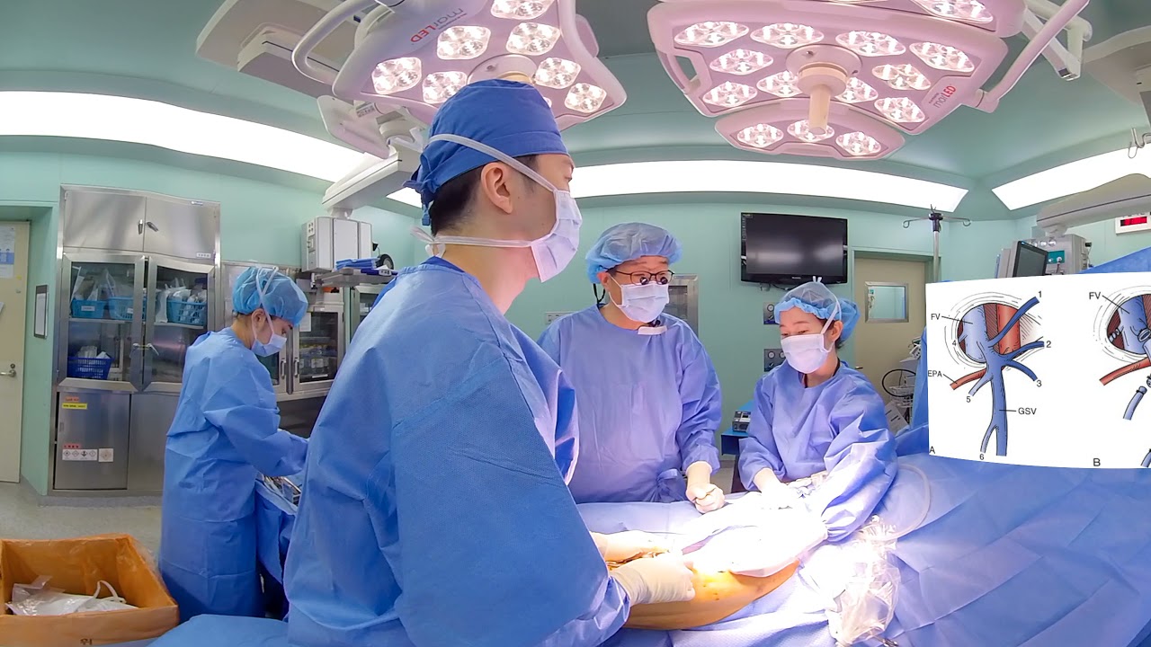 Varicose vein stripping - YouTube