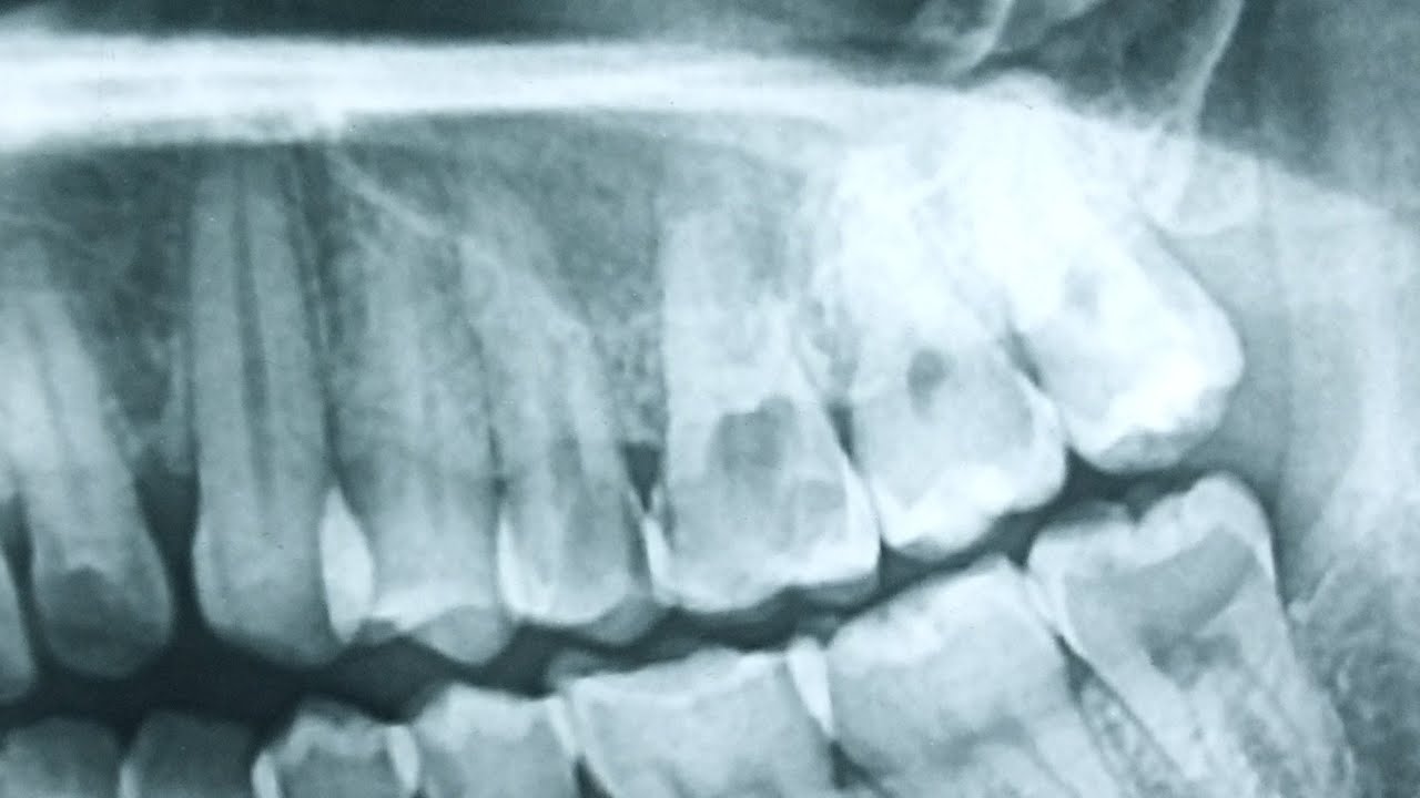 Root Canal Therapy upper left side 5,6 no teeth...upper molar root ...