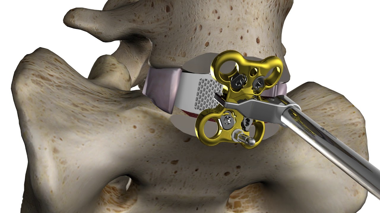 CoreLink Zou Anterior Lumbar Plate System - YouTube