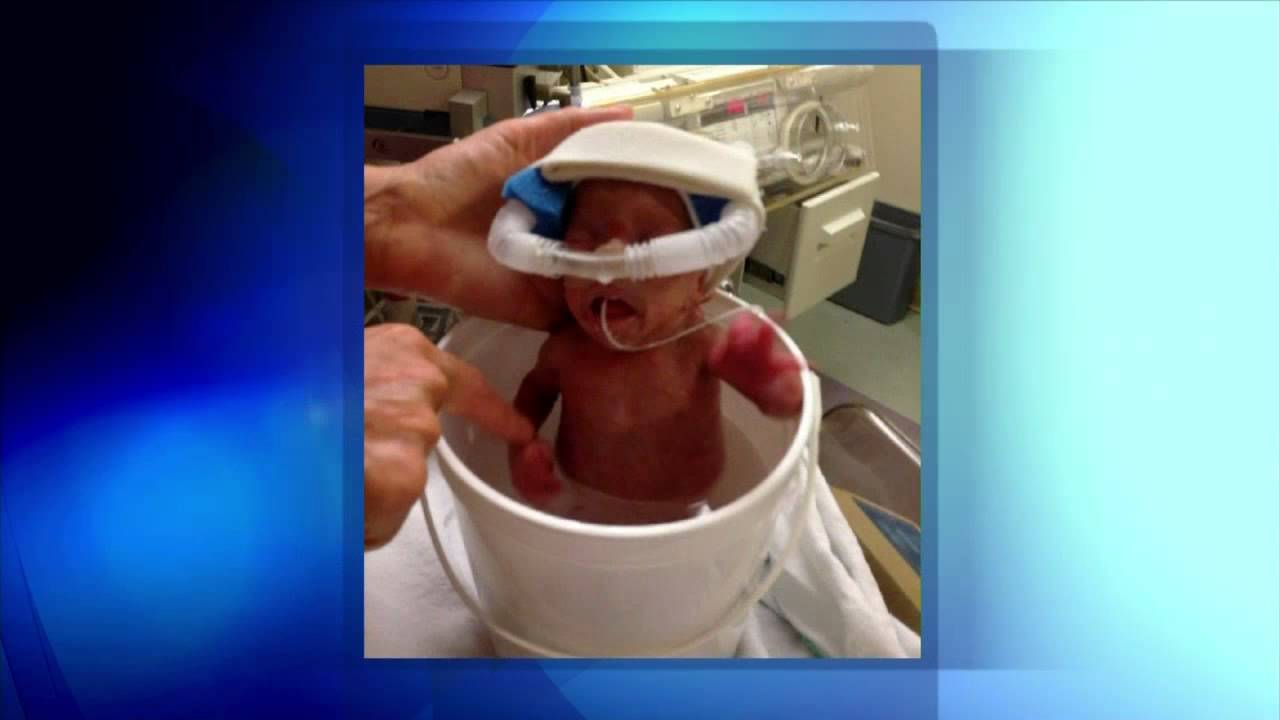 Preemie weighing only 330 grams now happy, healthy - YouTube