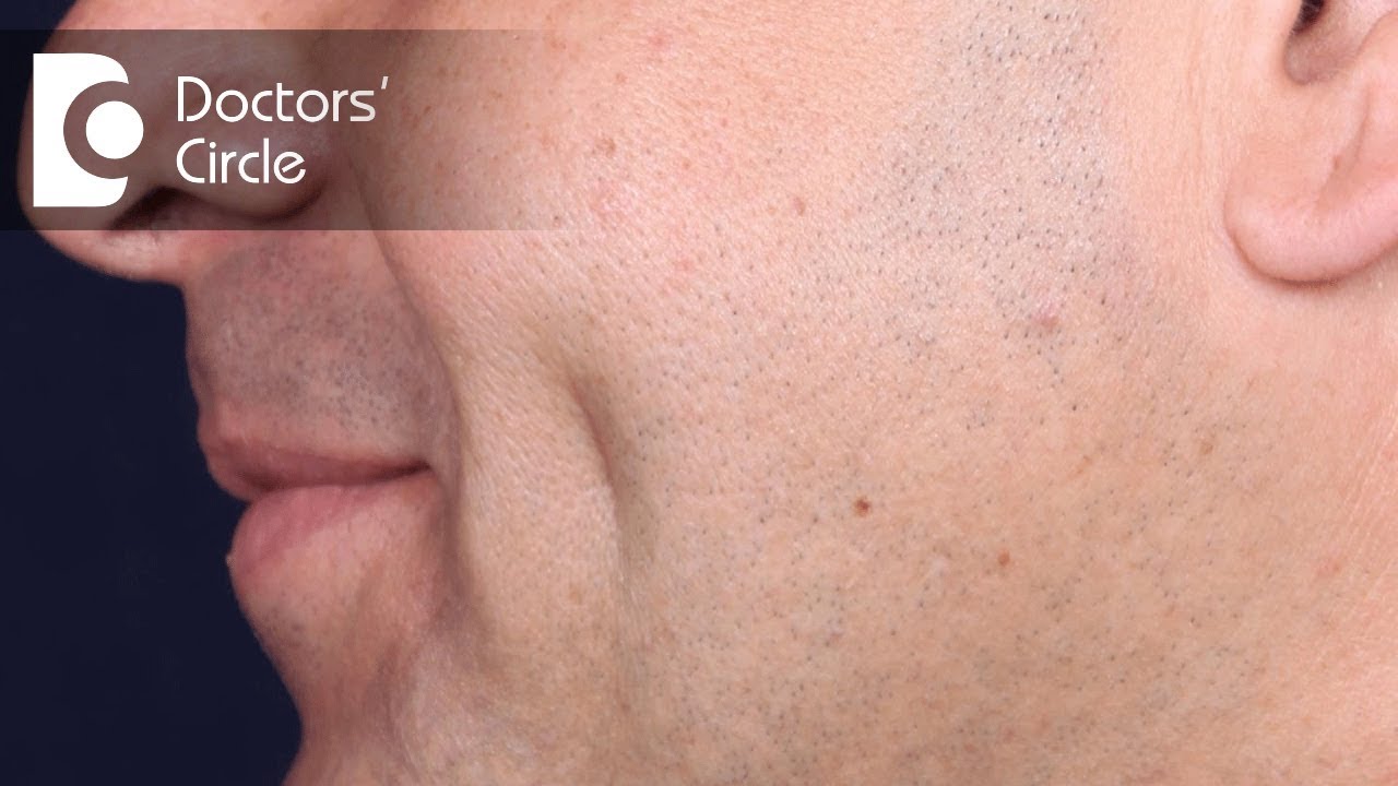 What is dimple creation & its procedure? - Dr. Girish A C | Doctors ...