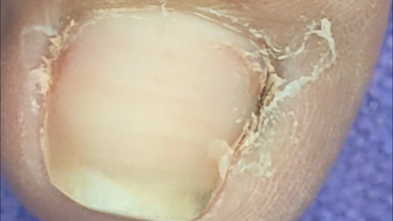 Nails hurt the footsteps deeply - YouTube