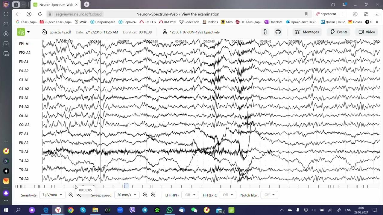 Online EEG viewer (web-based) - Neuron-Spectrum-WEB - YouTube