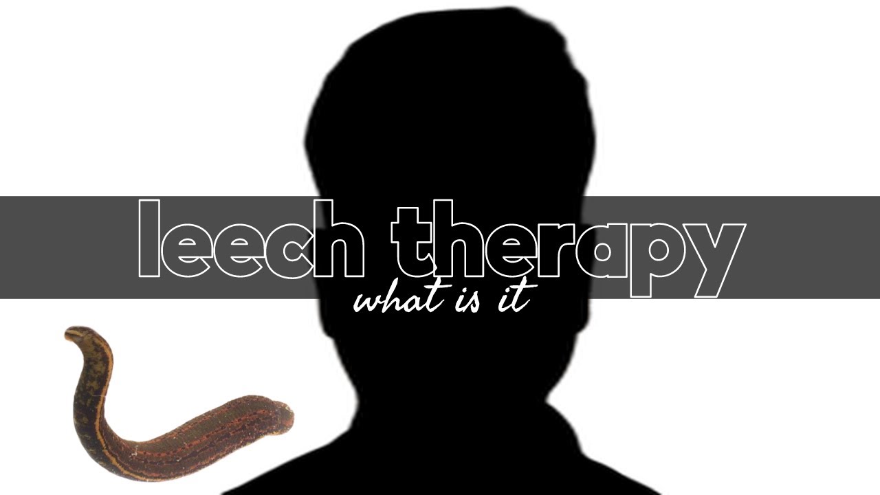 What is leech therapy? - YouTube