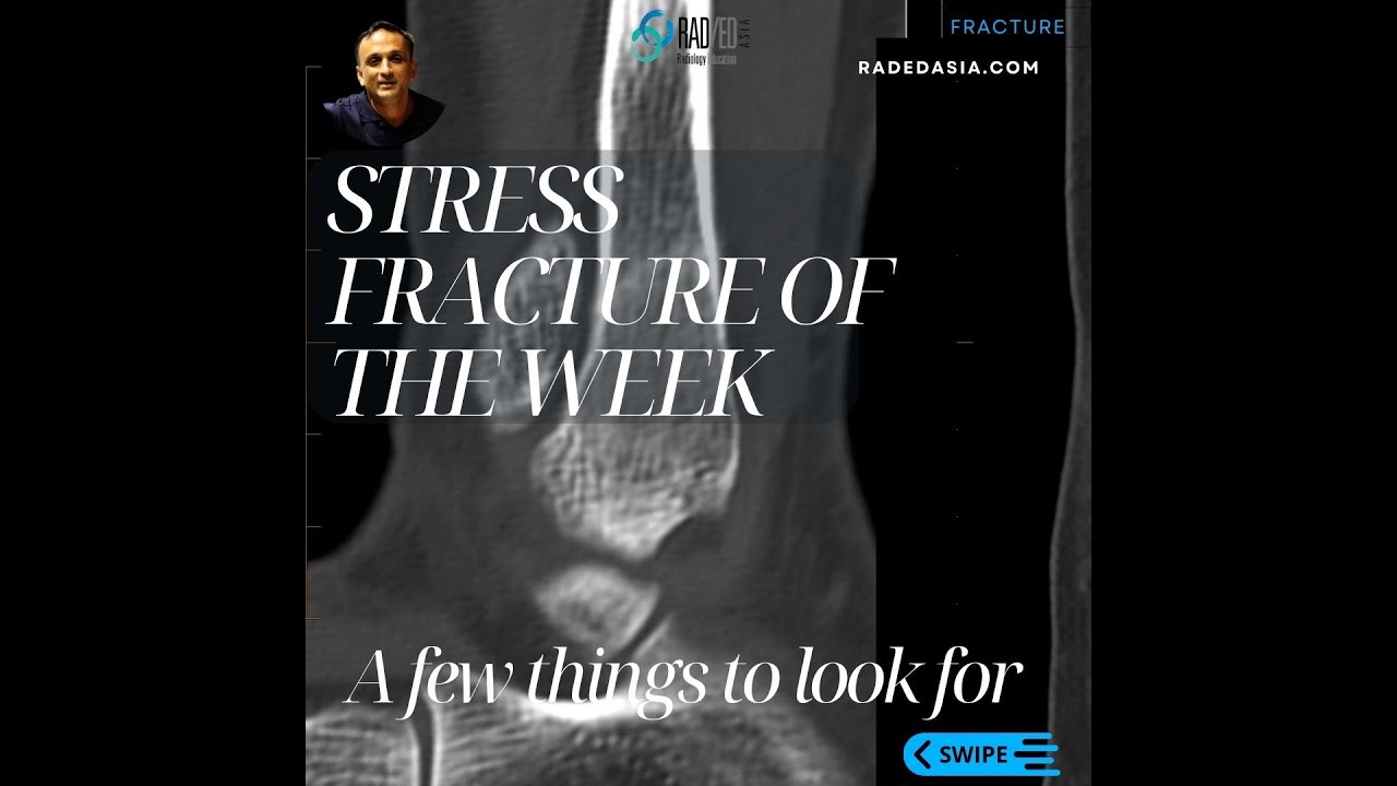 ANKLE STRESS FRACTURE SCLEROSIS MSK MRI RADIOLOGY - YouTube
