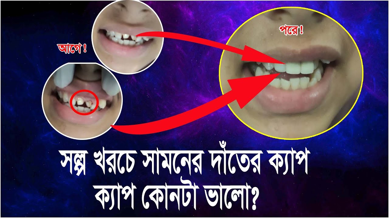 সামনের দাঁতের ক্যাপ কোনটা ভালো? - Dental cap Bridge Treatment bd ...