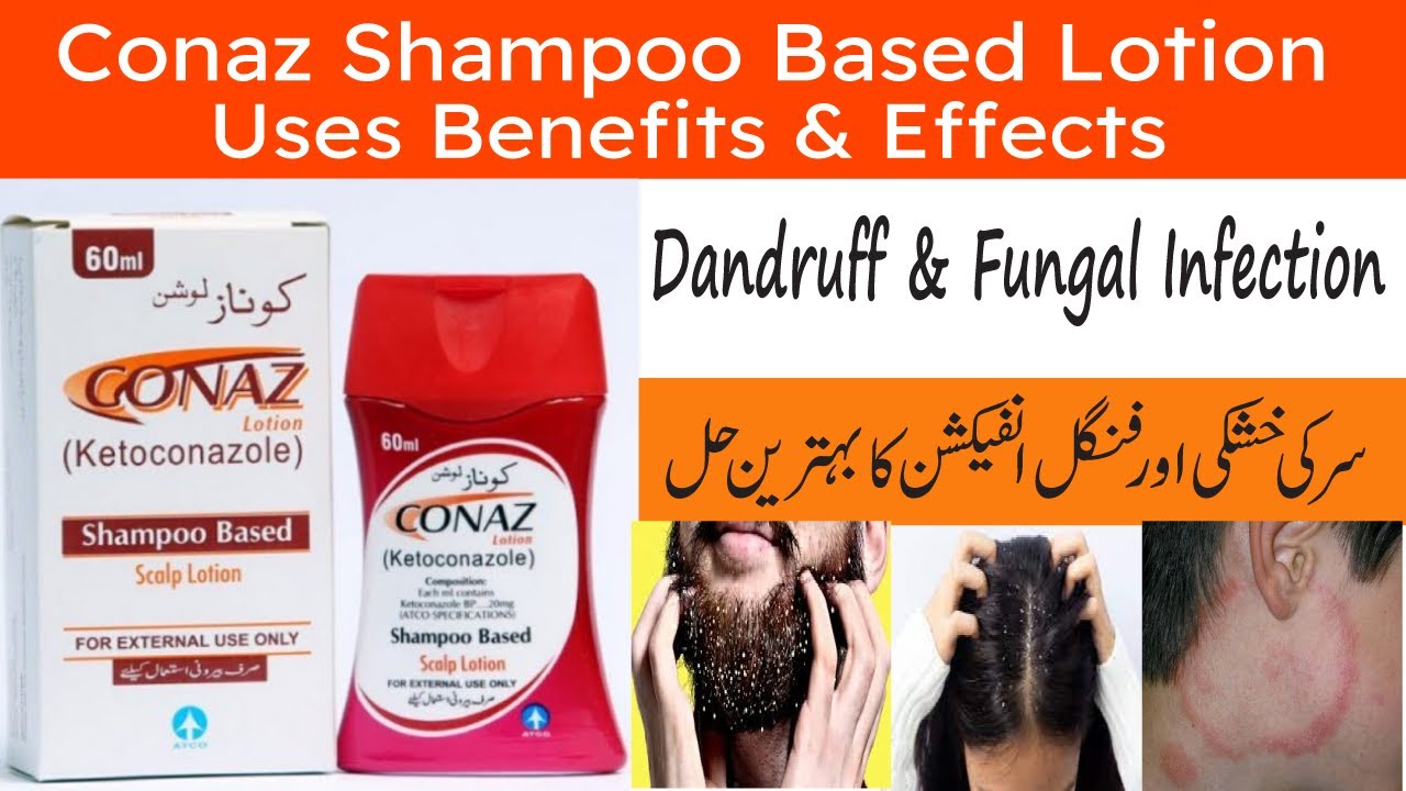 Conaz Shampoo Uses in Urdu | Best Anti dandruff shampoo | Antifungal ...
