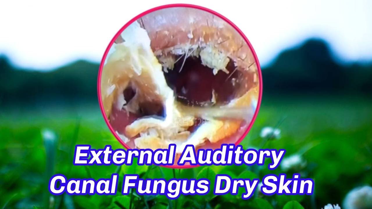 External Auditory Canal Fungus Dry Skin - YouTube