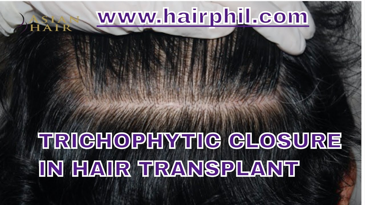 Trichophytic Closure in hair transplant - YouTube