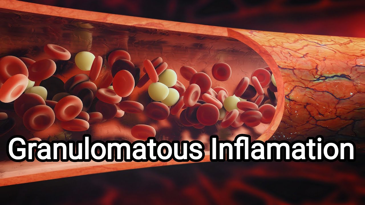 Granulomatous Inflamation: Definition and Pathogenesis - YouTube