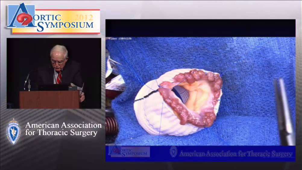 Pulmonary Autograft Stabilization Using a Valsalva Prosthesis - YouTube