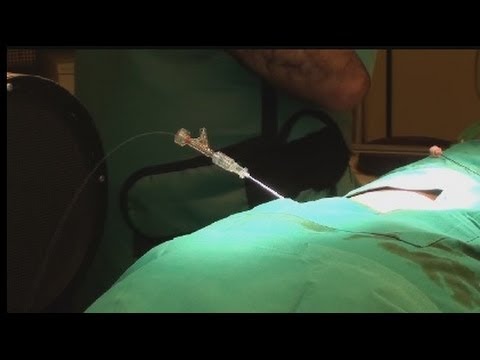Percutaneous Laser Disc Decompression (PLDD) - YouTube