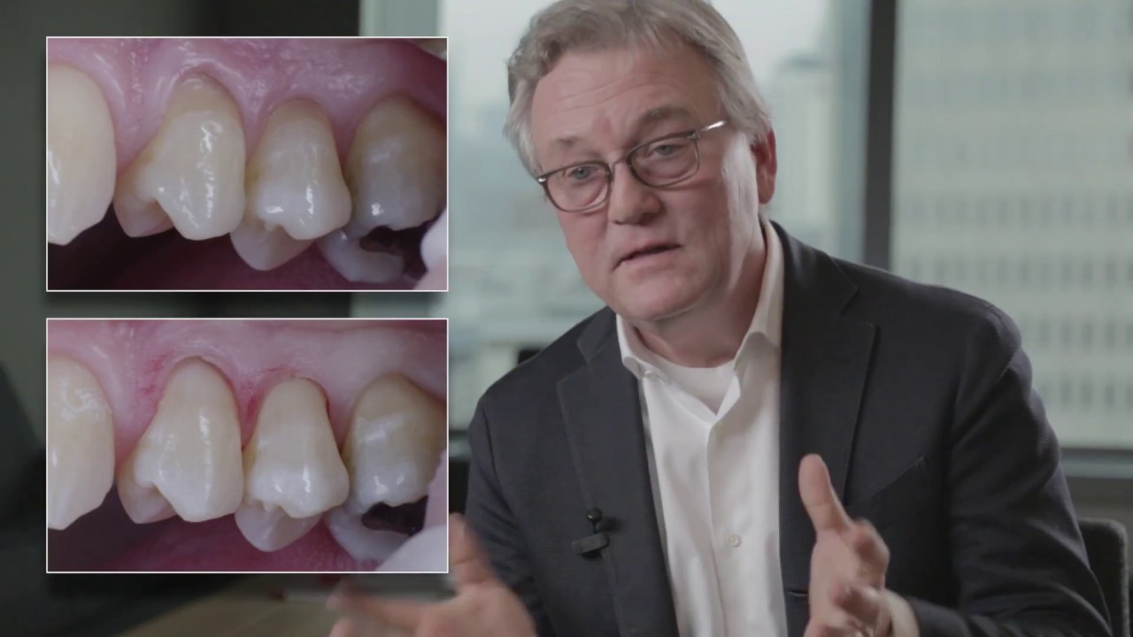 Step-by-step class V restorations-flow or conventional composite [EN ...