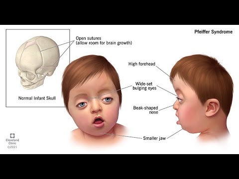 Pfeiffer Syndrome