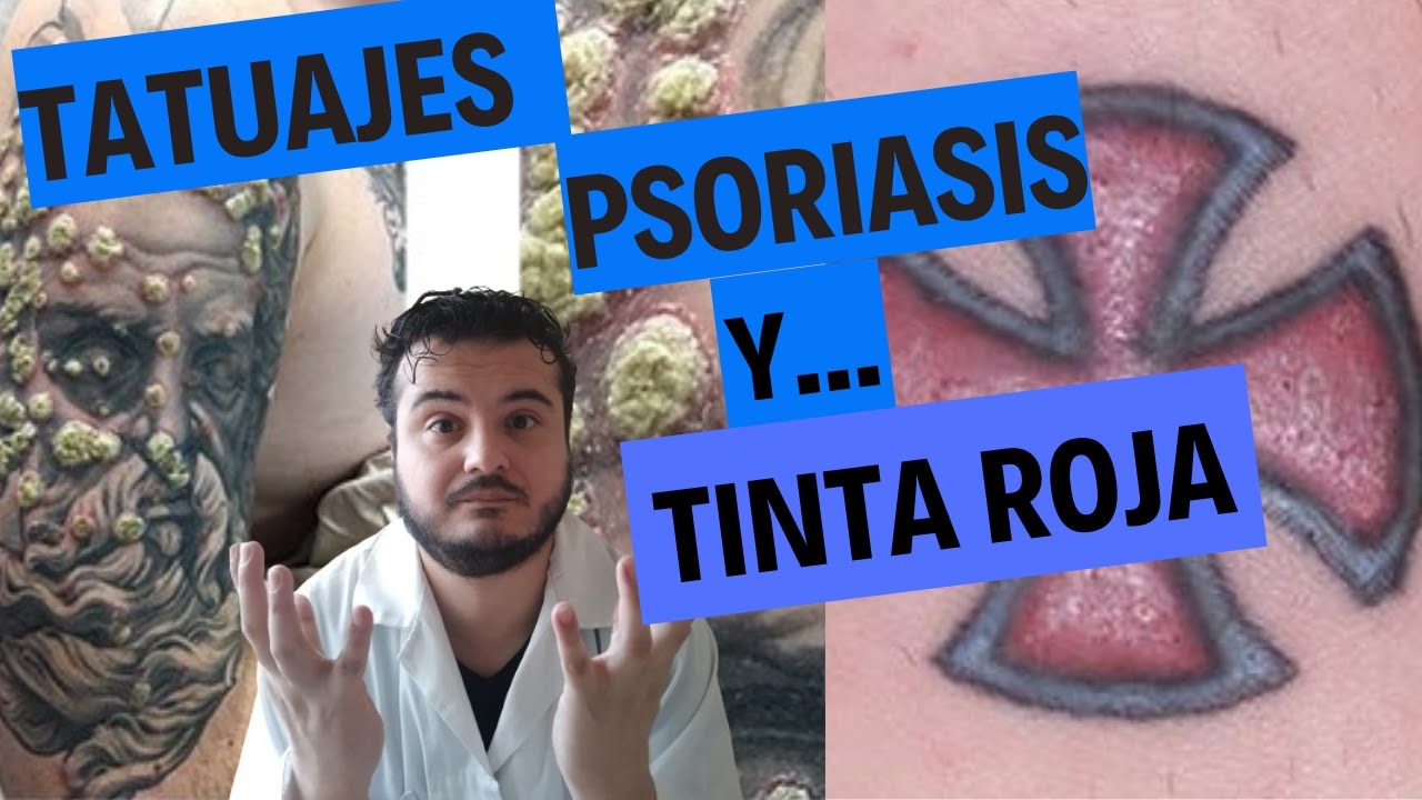 Dermatólogo responde acerca de alergia a tinta roja en tatuajes ...