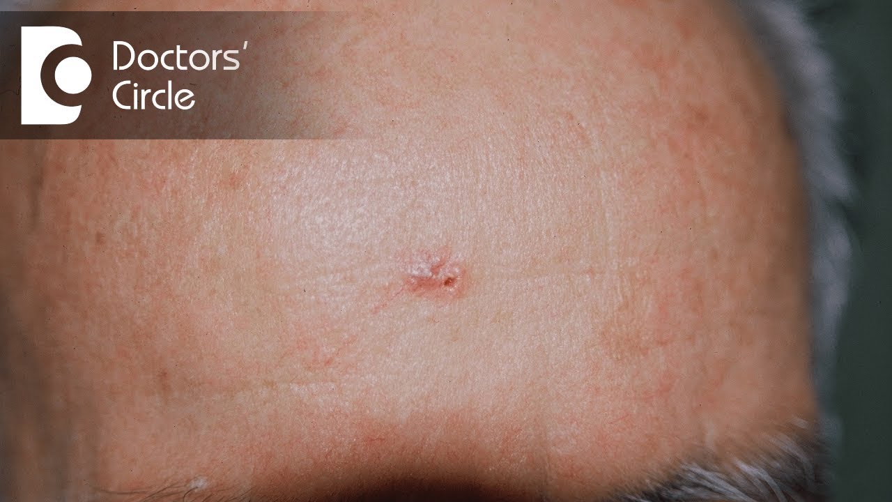 Which Chronic Ulcers Can Turn Into Skin Cancer Dr Sudheendra which-chronic-ulcers-can-turn-into-skin-cancer-dr-sudheendra