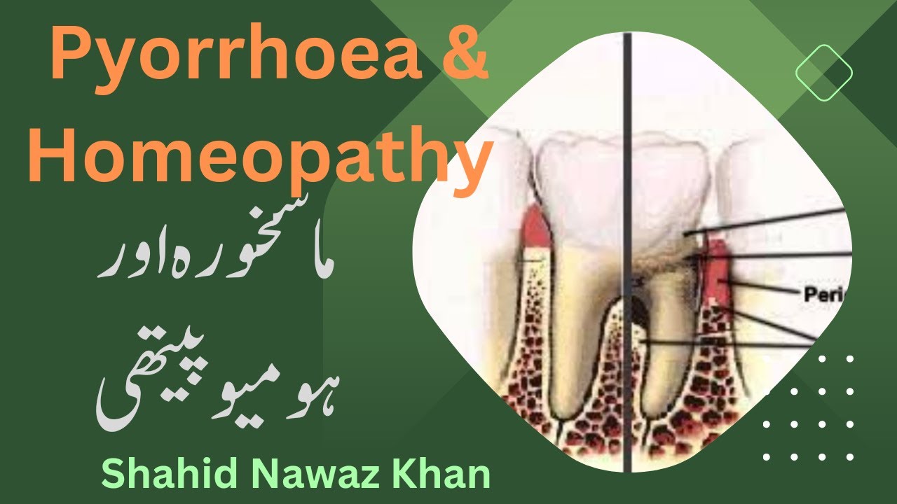 Pyorrhoea & Homeopathy | ماسخورہ اور ہومیوپیتھی | Shahid Nawaz Khan ...