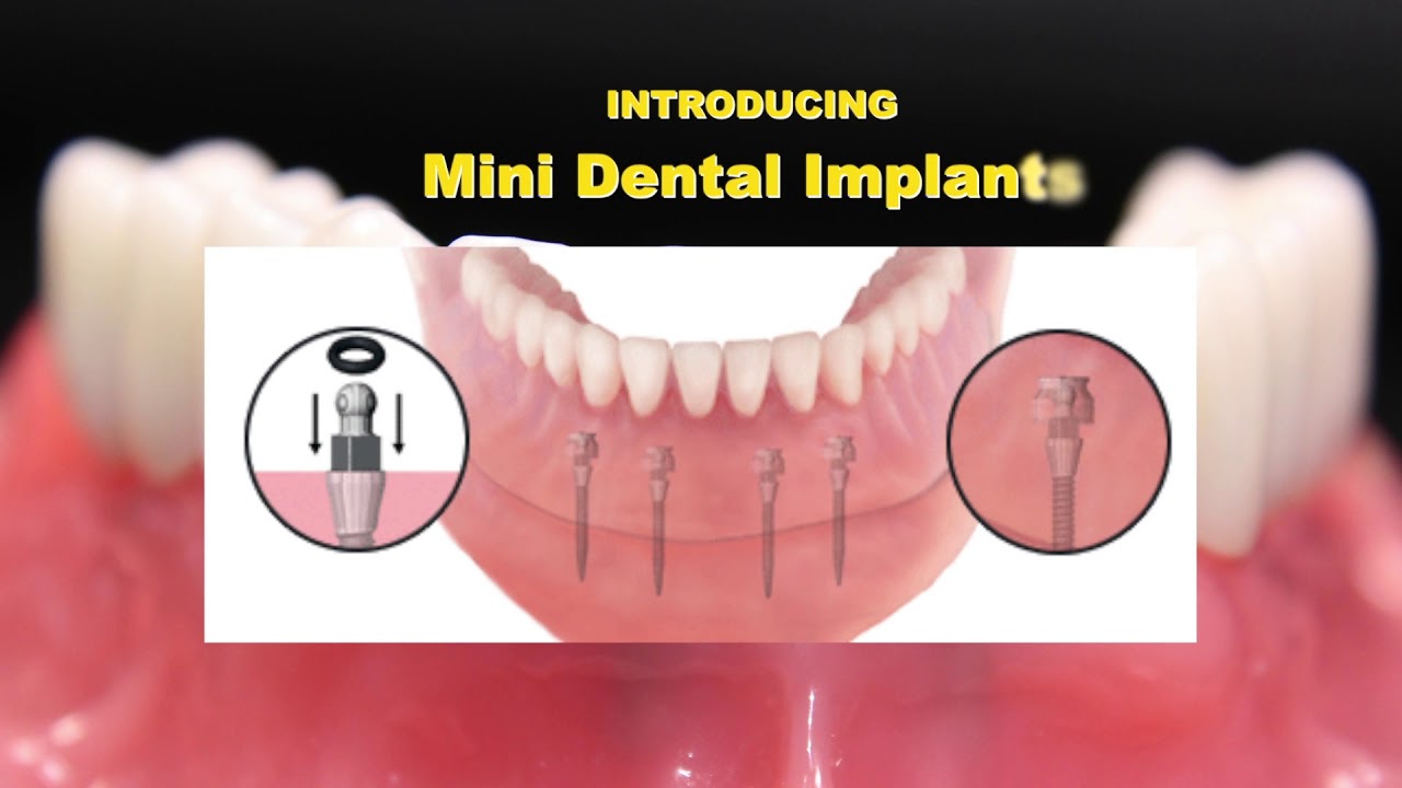 Dr Low 1 minute - Mini Dental Implants - YouTube