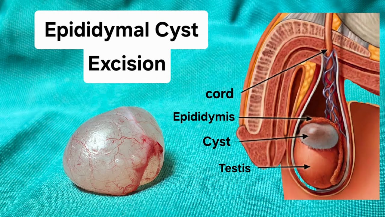 Epididymal Cyst Excision Dr Tayyab Riaz Ch YouTube Epididymal Cyst Excision Dr Tayyab Riaz Ch YouTube