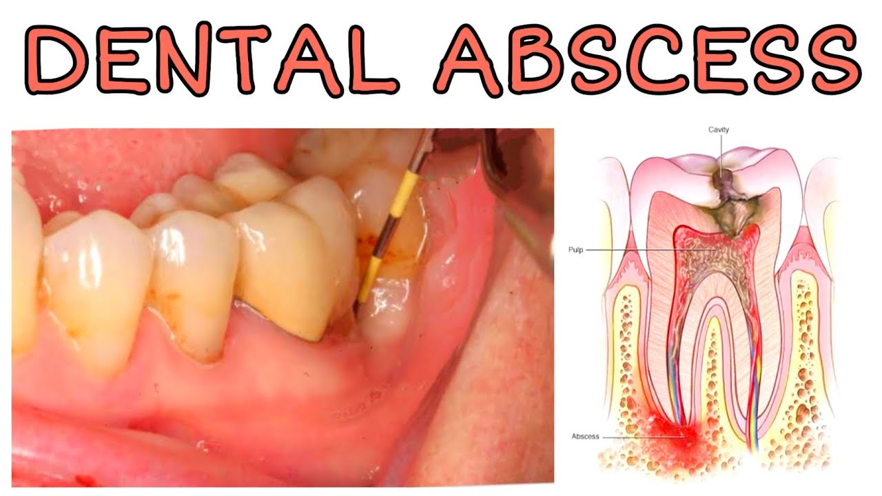 DENTAL ABSCESS | DEFINITION | TYPES | CAUSE | SYMPTOMS | DIAGNOSIS ...
