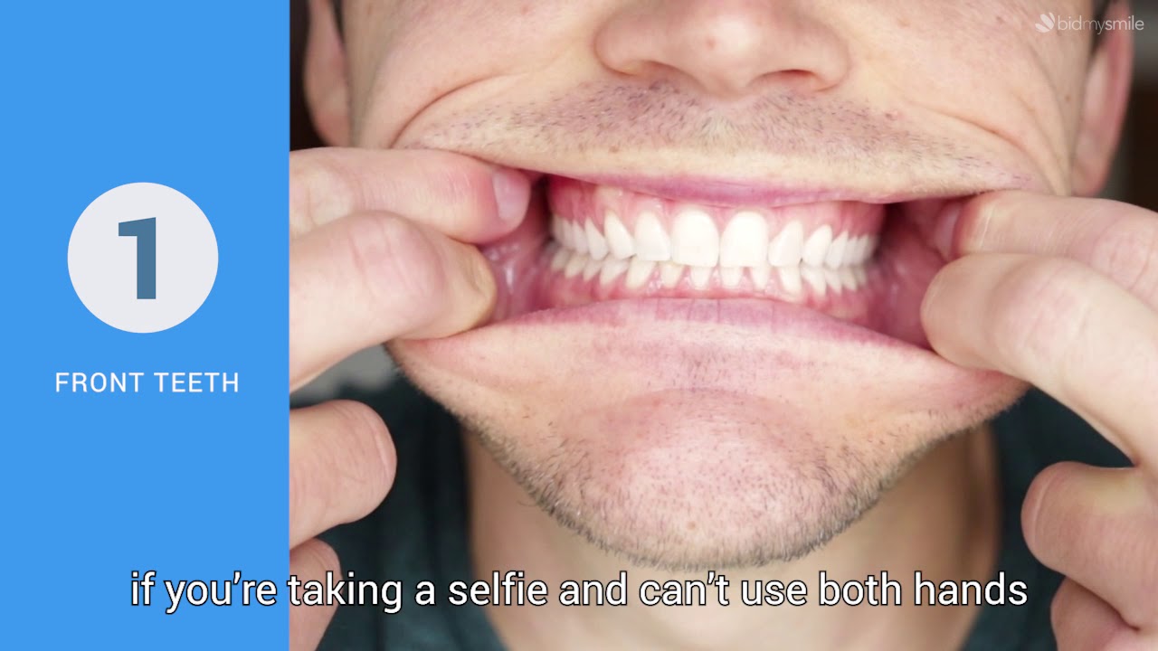 BidMySmile - Full "Teeth Selfie" Instructional - YouTube