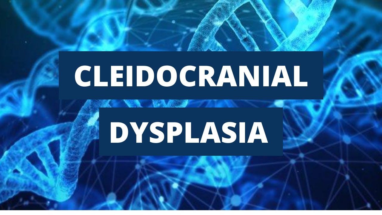 Cleidocranial Dysplasia -Introduction, Etiology, Clinical Features, and ...