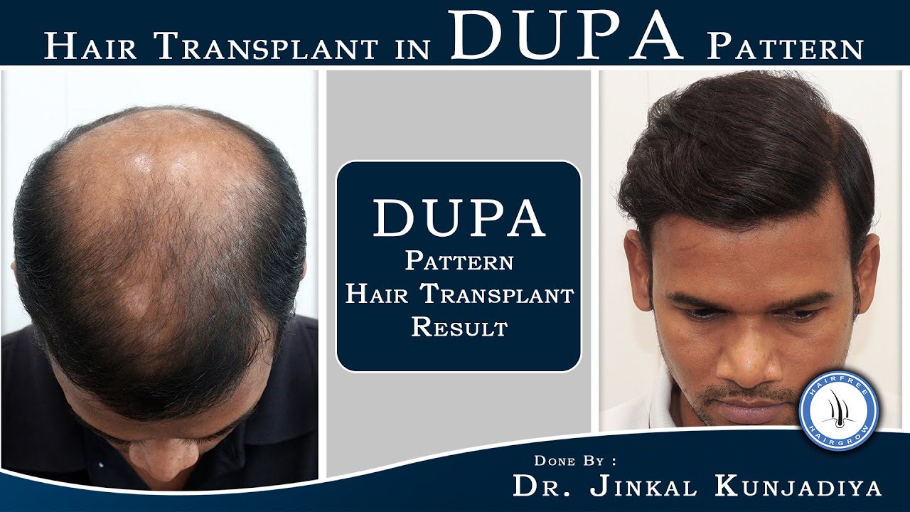 DUPA Pattern HairTransplant Result| Grade 6 Baldness | Patient Review ...