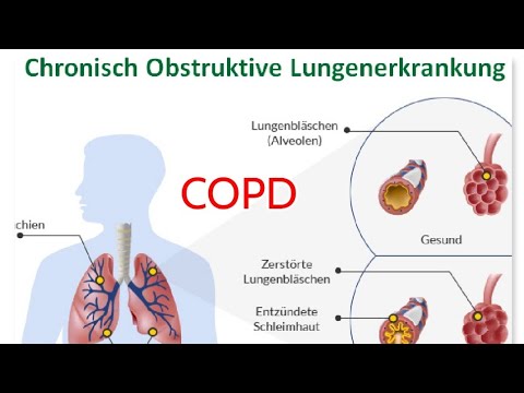 GOLD-Skala zur Einschätzung der COPD(chronisch - obstruktive ...