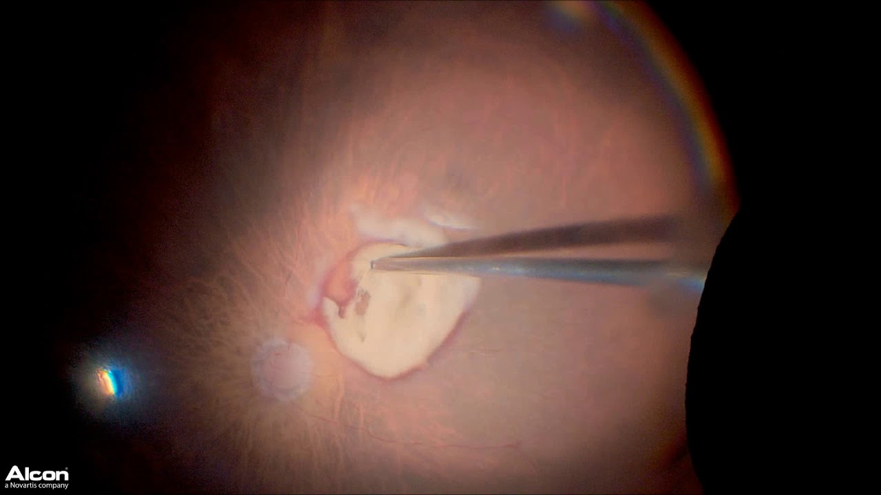 Vitrectomy for dehaemoglobined sub hyaloid haemorrhage over macula | Dr ...