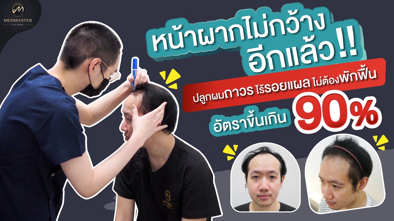 แก้ปัญหาหน้าผากกว้าง กับการปลูกผมถาวร แค่ 8 เดือน ผลลัพธ์ขึ้นเกิน 90% ...