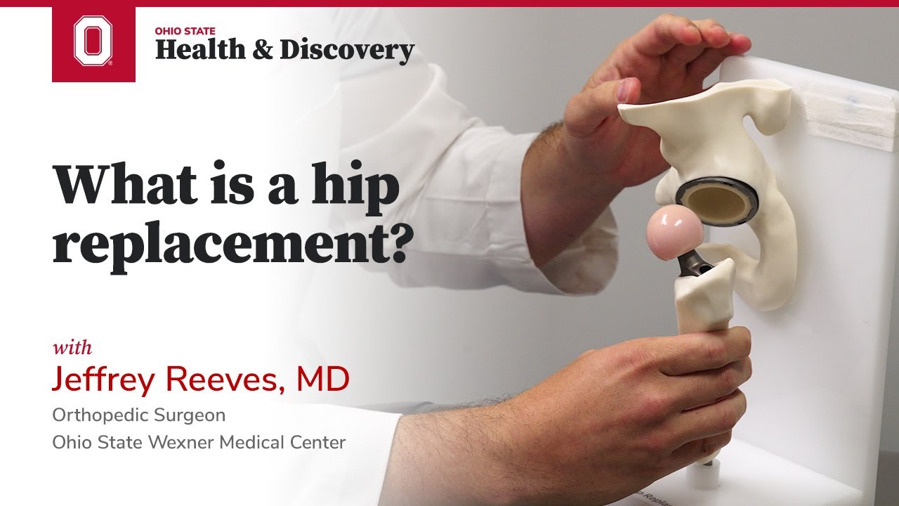 What is a hip replacement? | Ohio State Medical Center - YouTube