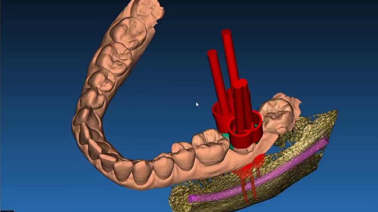 Trailer od a case of tooth autotransplantation performed with surgical ...