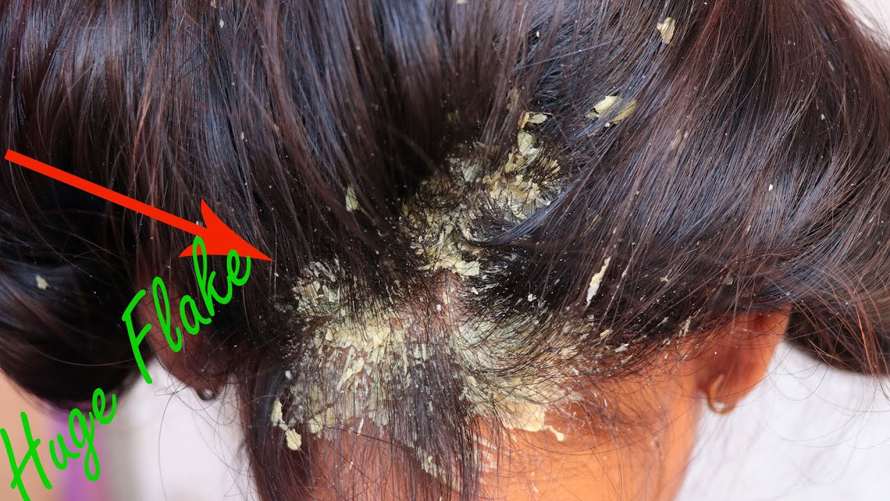 Wow Very Big Flakes!! Scalp Scratching and Picking Dandruff | Mr ...