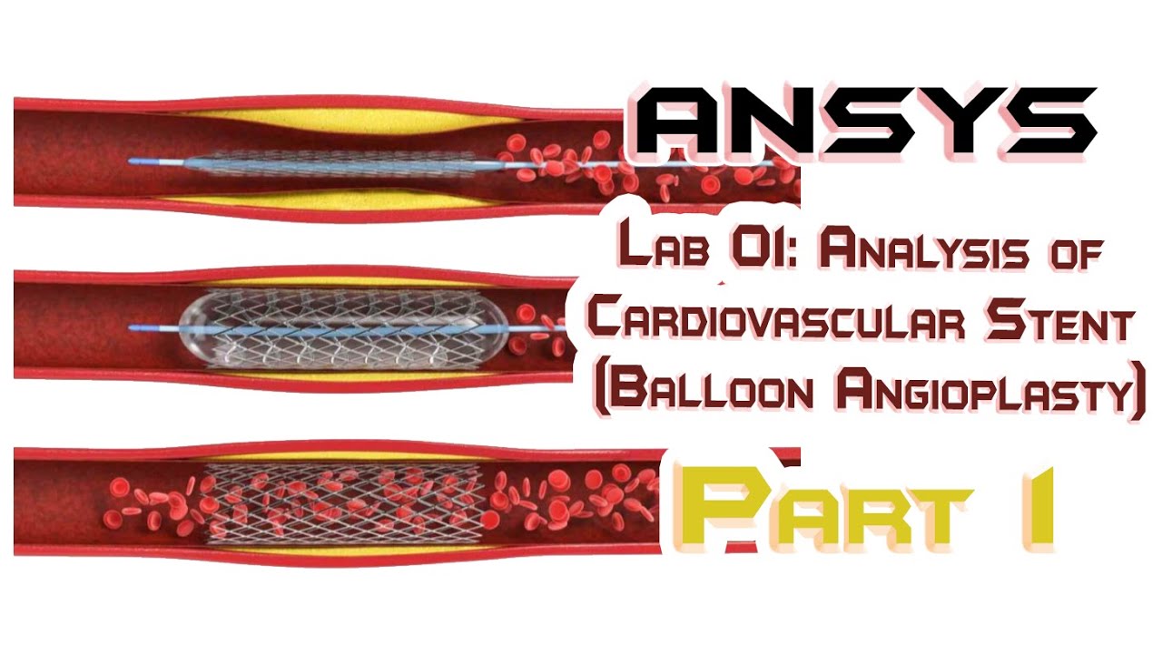 Lab 01-Analysis of a Cardiovascular Stent in Balloon Angioplasty (Part ...
