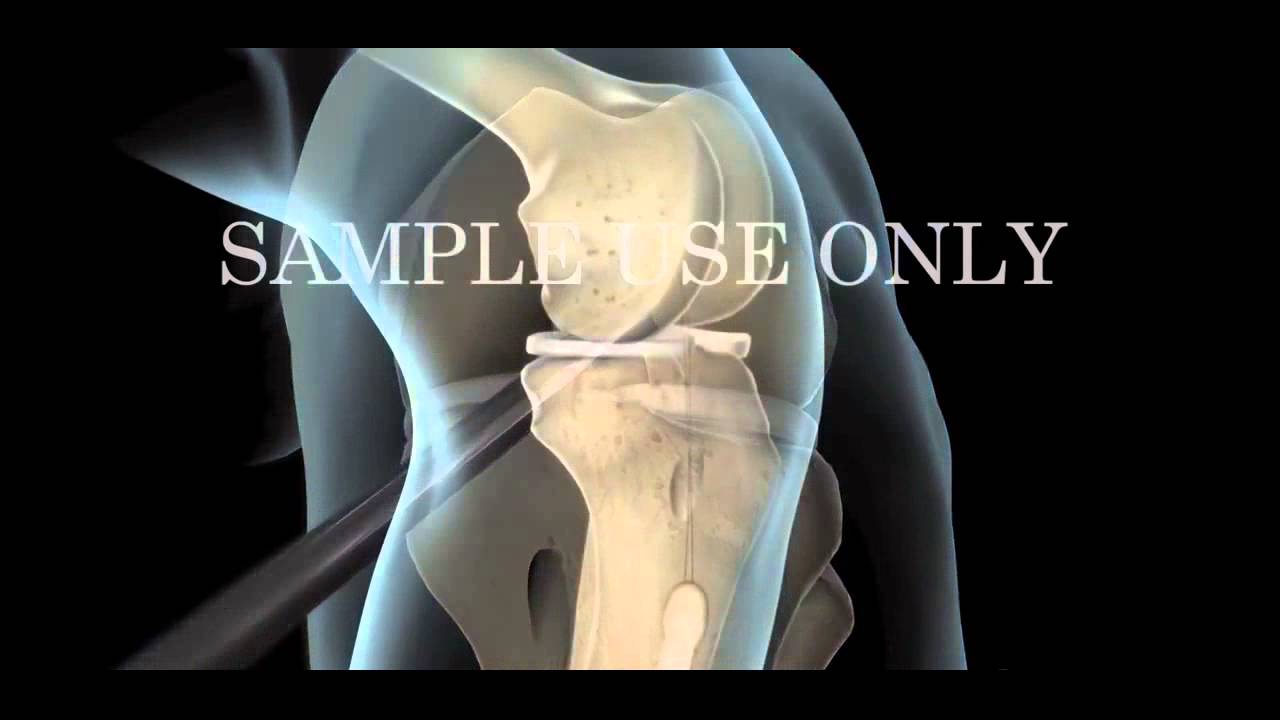 Joint Replacement Surgery in Bangalore | ACL Reconstruction Surgery ...