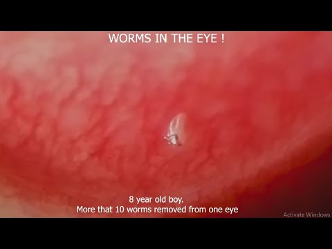 Worms in the eye Treated By Dr. Sahebaan Sethi | Best Eye Doctor in ...