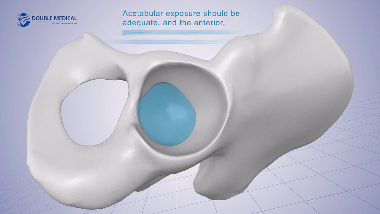 Double Medical Apollo Acetabular Cup System - YouTube