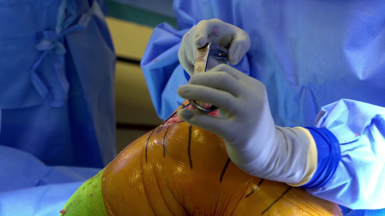 Dr Assini - Total Knee Arthroplasty - YouTube