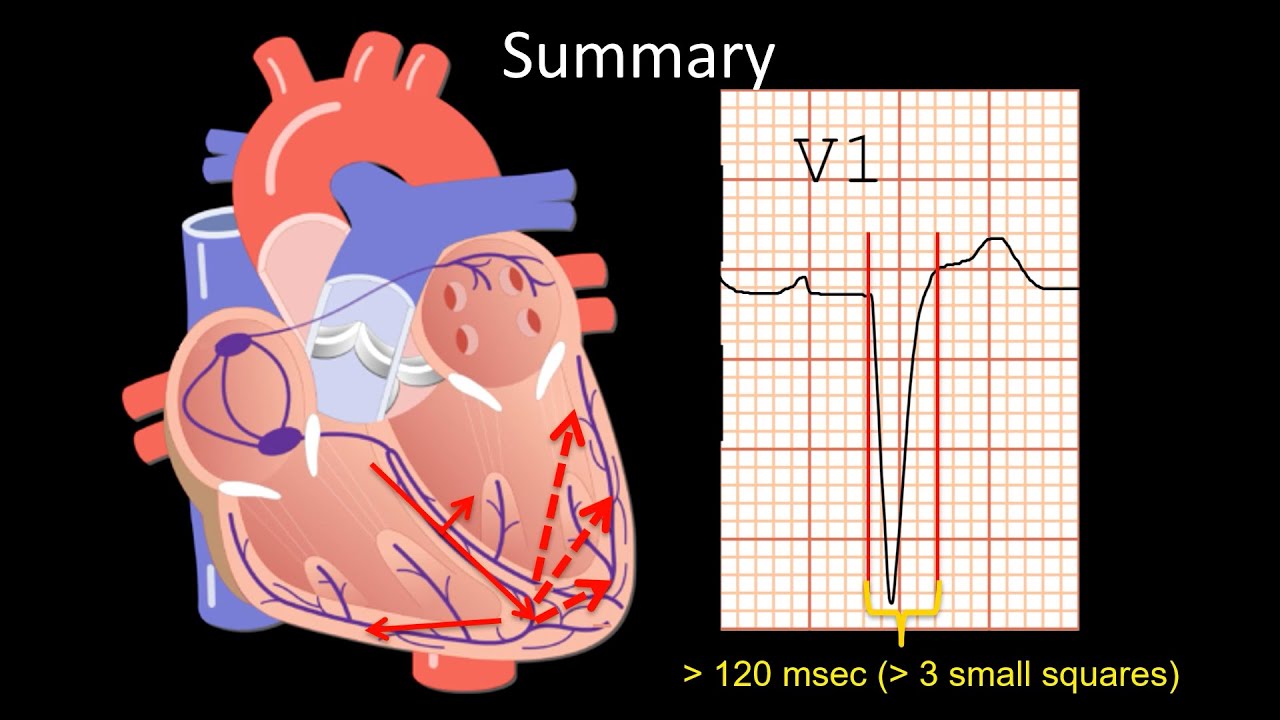 How to Read an ECG: Left Bundle Branch Block (LBBB) - YouTube