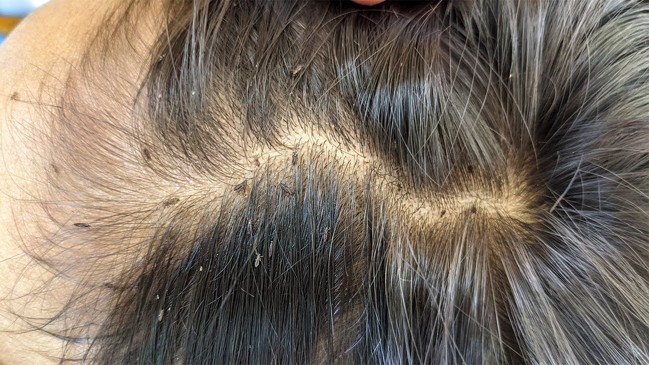 Finding all of lice which hidden in hair - Remove all lice from long ...